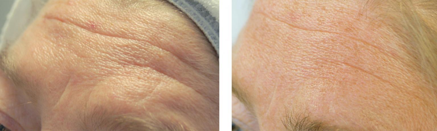 Microneedling - Beauty Centre Jolanda